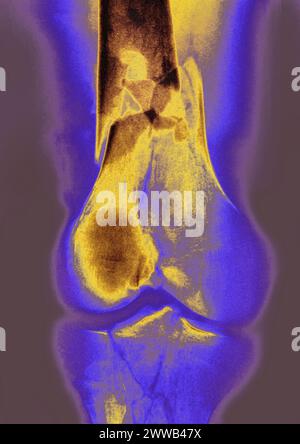 Knee fracture (caused by a violent shock, causing trauma with serious ...