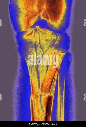 Knee fracture (caused by a violent shock, causing trauma with serious ...