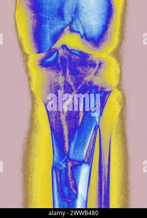 Knee fracture (caused by a violent shock, causing trauma with serious ...