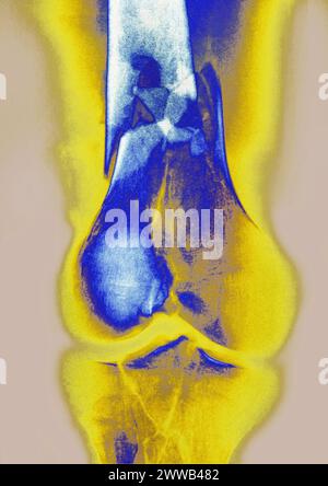 Knee fracture (caused by a violent shock, causing trauma with serious ...