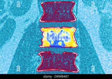 Vertebral osteitis (inflammation of the bone tissue of a lumbar ...