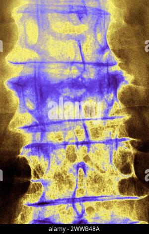 Vertebral osteoporosis (bone disease characterized by a decrease in ...