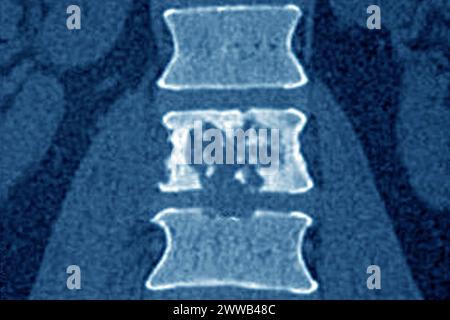 Vertebral osteitis (inflammation of the bone tissue of a lumbar ...