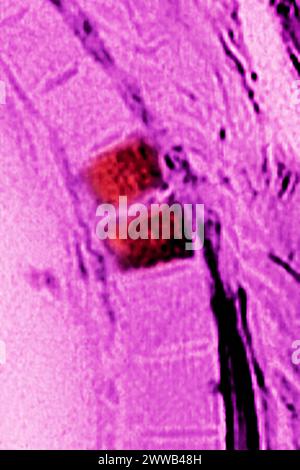 Vertebral osteitis (inflammation of bone tissue in a dorsal vertebra ...