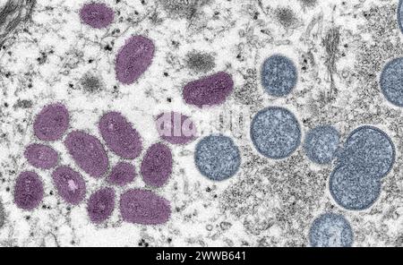 This electron microscopic (EM) image depicts monkeypox virus particles ...