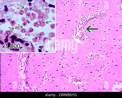 A section of the brain of a patient with primary amoebic ...