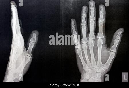 Plain x ray of the left hand of an adult male after a direct trauma to ...