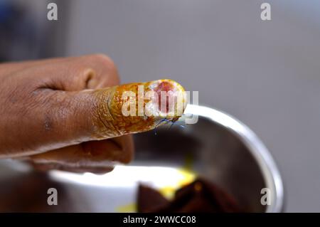a thumb of the left hand with surgical removal of the thumb nail, and ...