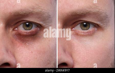 Collage with photos of man with dark circle under eye before and after ...