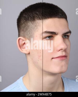 Acne problem, collage. Photo of man divided into halves before and ...