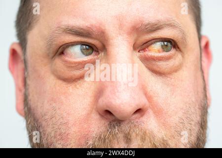 Redness of the eye, possible consequences of capillary rupture or ...