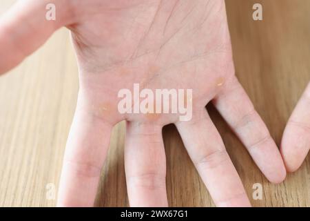 Calluses or corns on palmar surface of hand Stock Photo - Alamy