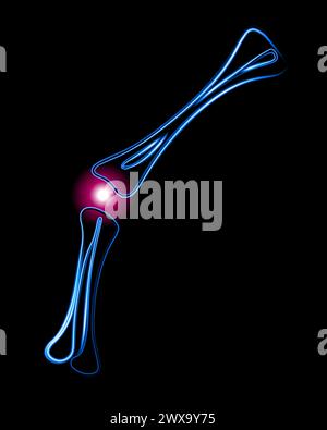 Healthy human knee, joint inflammation, and Osteoarthritis or ...