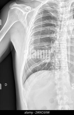 Xray of a human chest with broken ribs Stock Photo - Alamy