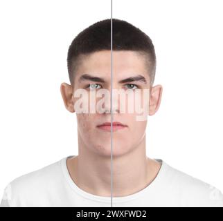 Acne problem, collage. Photo of man divided into halves before and ...