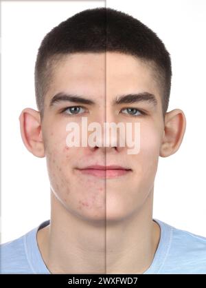 Acne problem, collage. Photo of man divided into halves before and ...