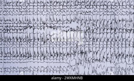 Imaging of ictal EEG recording in epilepsy patient during monitoring ...