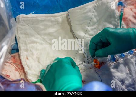 Heart stent placement process in operating room. Heart doctor inserting ...