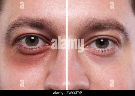Collage with photos of man with dark circle under eye before and after ...