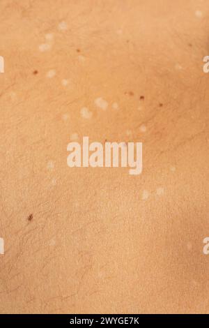 Candidiasis fungal infection Stock Photo - Alamy