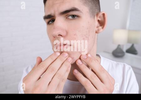 Upset young man touching pimple on his face indoors. Acne problem Stock ...