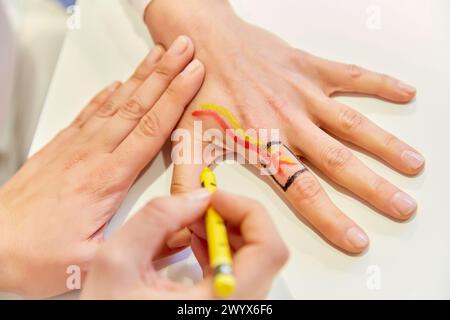 Hand. Flap. Hand surgery. In reconstructive surgery tips, flaps is one ...