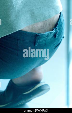 Close-up of the buttock of an adult male patient, showing an infected ...