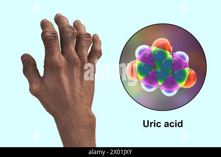 Illustration of gout-afflicted hands with deformities, revealing the ...