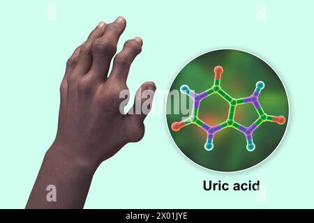 Illustration of gout-afflicted hands with deformities, revealing the ...