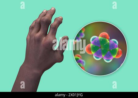 Illustration of gout-afflicted hands with deformities, revealing the ...