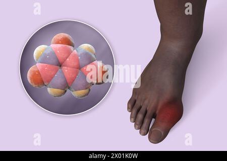 Illustration of gout-afflicted foot and close-up view of uric acid ...