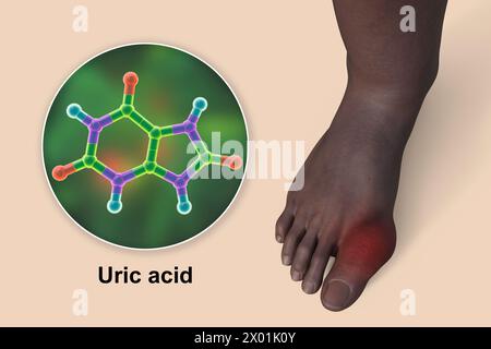 Illustration of gout-afflicted foot and close-up view of uric acid ...