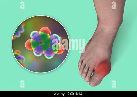 Illustration of gout-afflicted foot and close-up view of uric acid ...