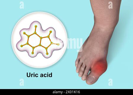 Illustration of gout-afflicted foot and close-up view of uric acid ...