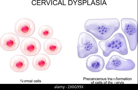 Cervical dysplasia. Close-up of a cervix. Cervical cancer. Cervical ...