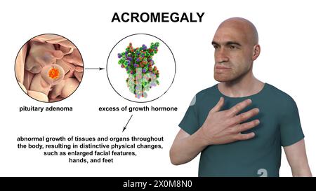 3D illustration of a man with acromegaly. This is a condition causing ...