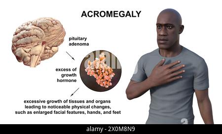 Acromegaly in a man, illustration Stock Photo - Alamy