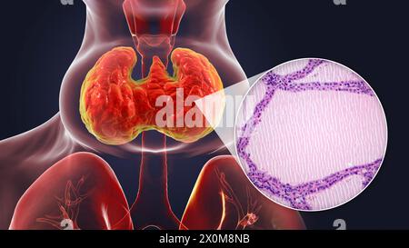 3D illustration of a person with an endemic goitre (enlarged thyroid ...