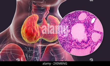 3D illustration of a person with a toxic goitre (enlarged thyroid gland ...