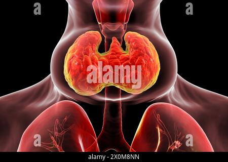 3D illustration of a woman with an enlarged thyroid gland, known as a ...