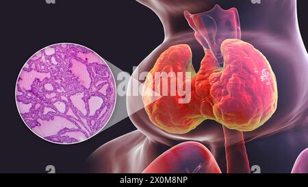 3D illustration of a person with an enlarged thyroid gland (base of ...
