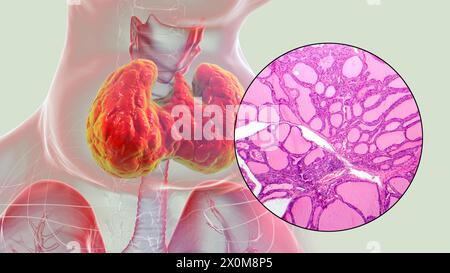 3D illustration of a person with an enlarged thyroid gland (base of ...