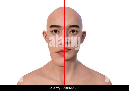 3D illustration comparing a man with acromegaly (left) and the same ...