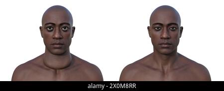 3D illustration of a man with an enlarged thyroid gland (base of neck ...