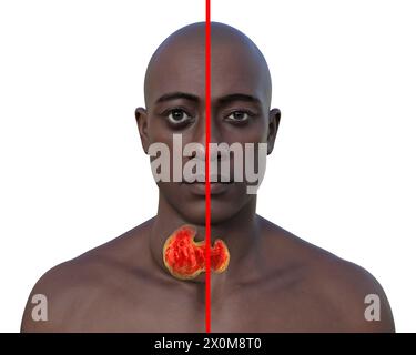 3D illustration of a man with a healthy thyroid gland (red). The ...