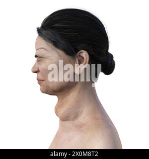 3D illustration of a woman with an enlarged thyroid gland, known as a ...