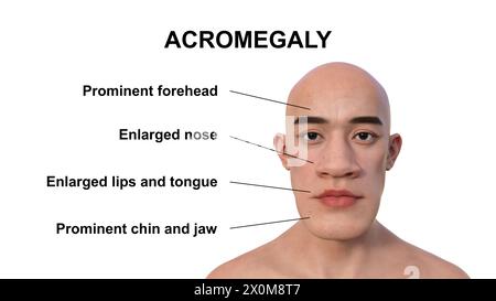 Acromegaly in a man, illustration Stock Photo - Alamy