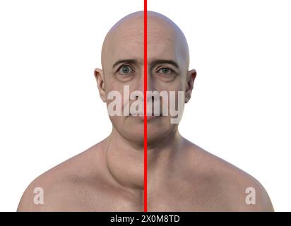 3D illustration of a man with an endemic goitre, and a close-up of the ...