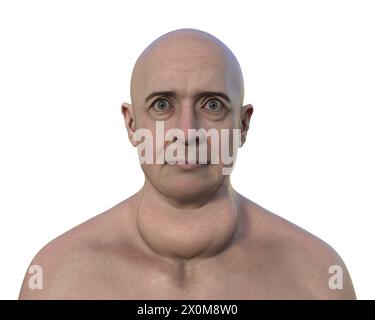 3D illustration of a man with an endemic goitre, and a close-up of the ...