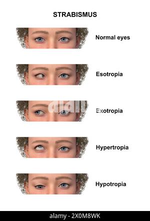 Illustration of a child with various strabismus types: esotropia ...
